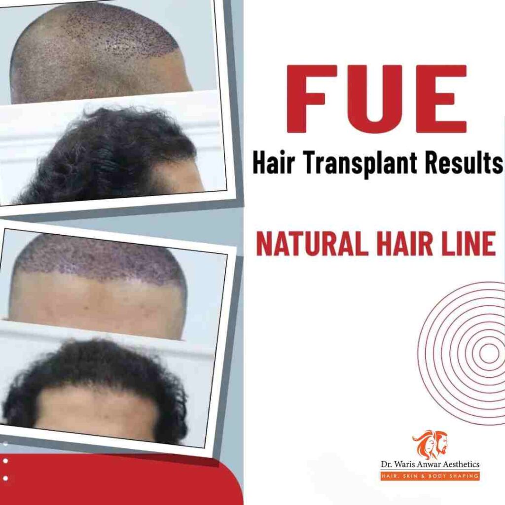 FUE (Follicular Unit Extraction)