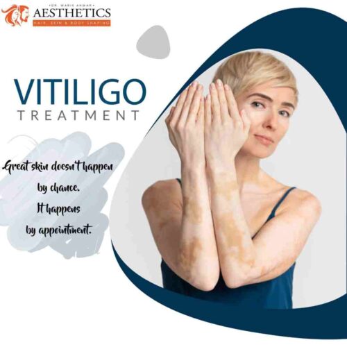 Vitiligo Treatment - Dr Waris Anwar Aesthetics